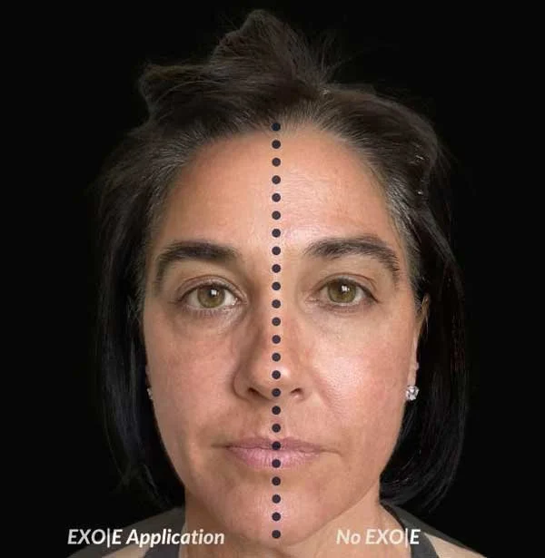 Exosome Therapy in Ann Arbor and Wyandotte — Med 1 Aesthetics