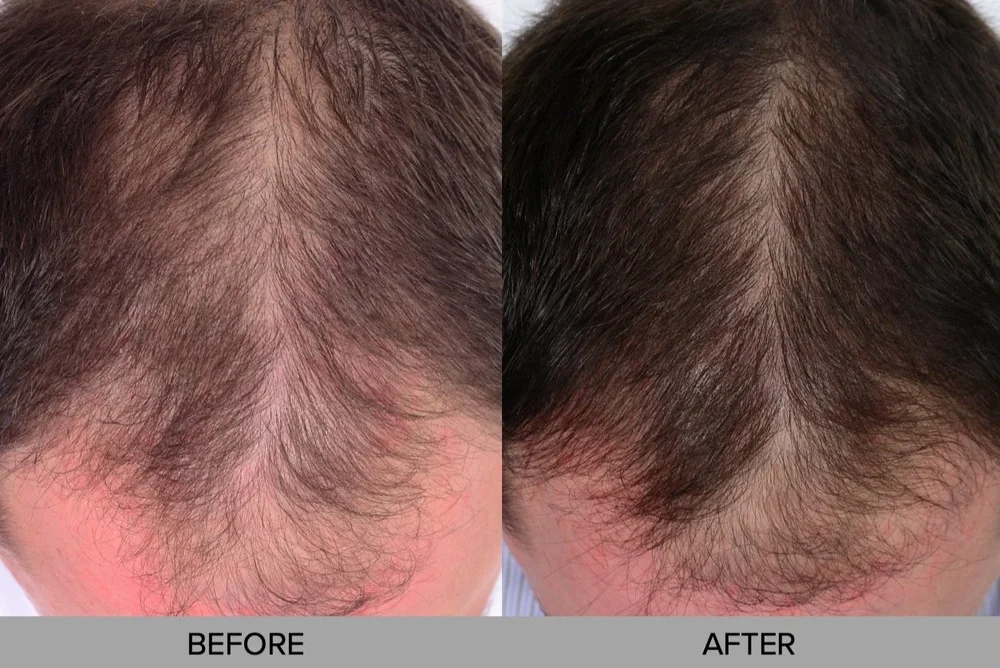 PRP Hair Restoration | Ann Arbor & Wyandotte Michigan — Med 1 Aesthetics