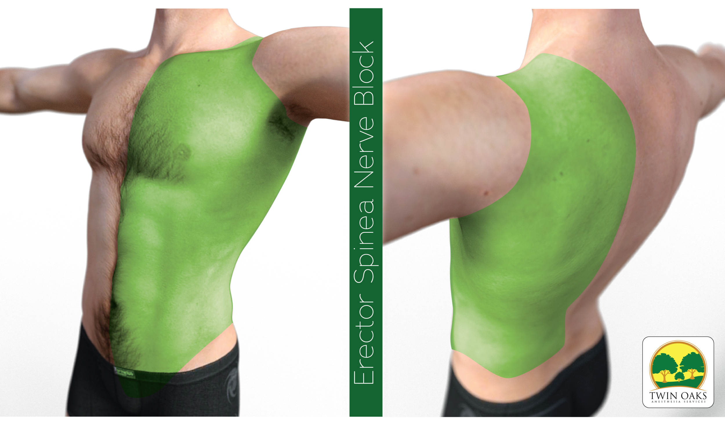 Erector Spinea Block — CRNA Conferences - Twin Oaks Anesthesia