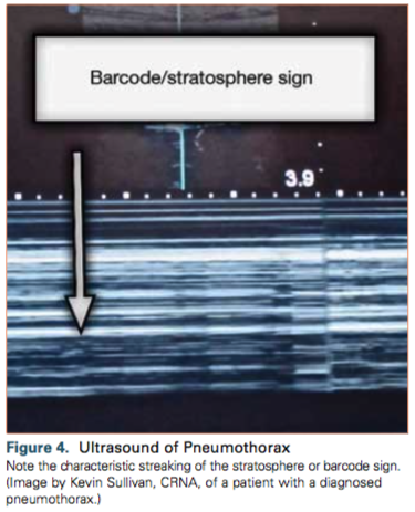 Detection of Pneumothorax with Ultrasound — CRNA Conferences - Twin ...