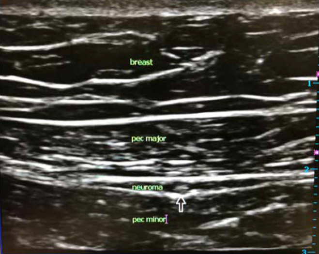 Pectoral Nerve Neuroma article — CRNA Conferences - Twin Oaks Anesthesia