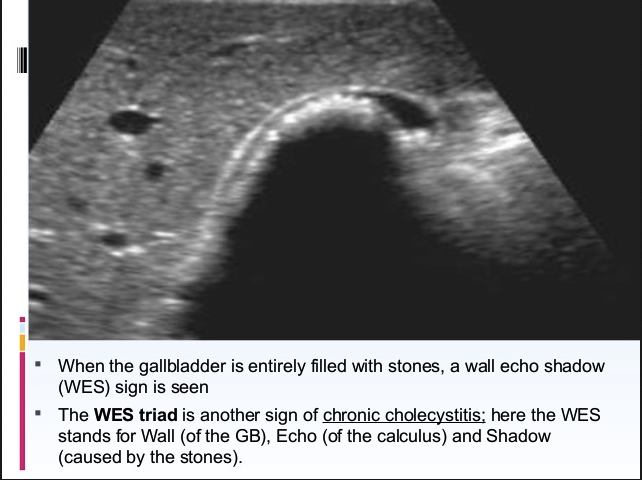 Chronic Cholecystitis Ultrasound Wes Sign