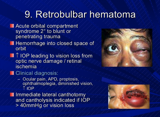 Retrobulbar Hematoma