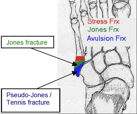 Jones Fracture