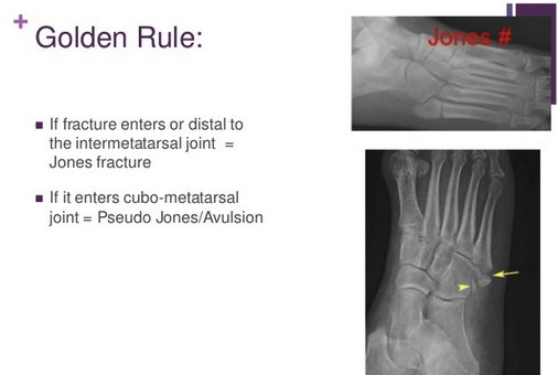 Pseudo Jones Fracture