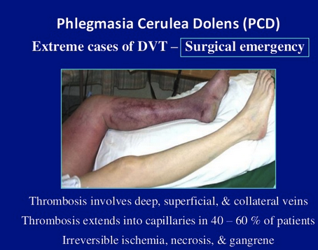 Phlegmasia Cerulea Dolens