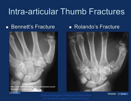 Rolando Vs Bennett Fracture