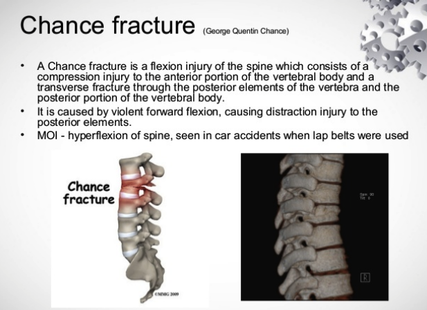 Chance Fracture Seat Belt