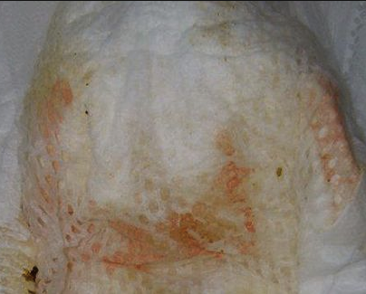 Uric Acid Crystals In Diaper