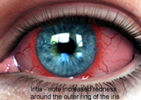 Conjunctival Injection