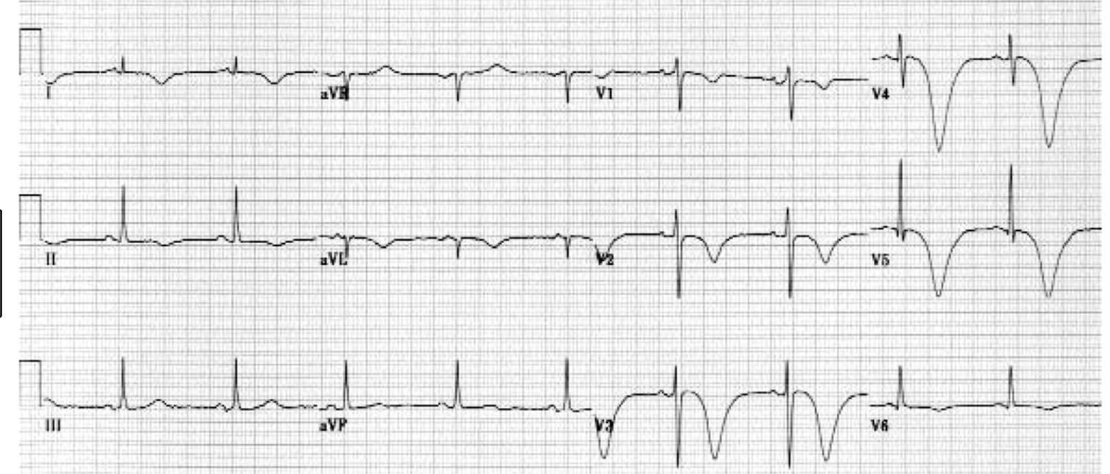 T Wave Elevation
