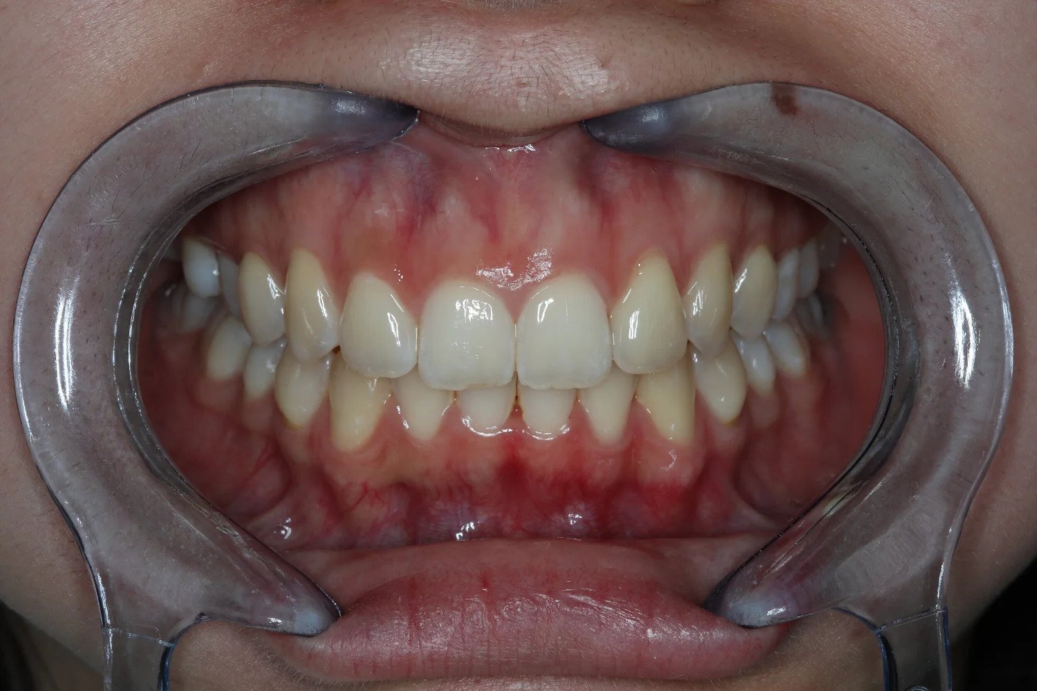 Can Invisalign Fix Canine Teeth