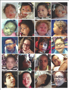 Bohring-Opitz Syndrome Foundation, Inc. Clinical Features