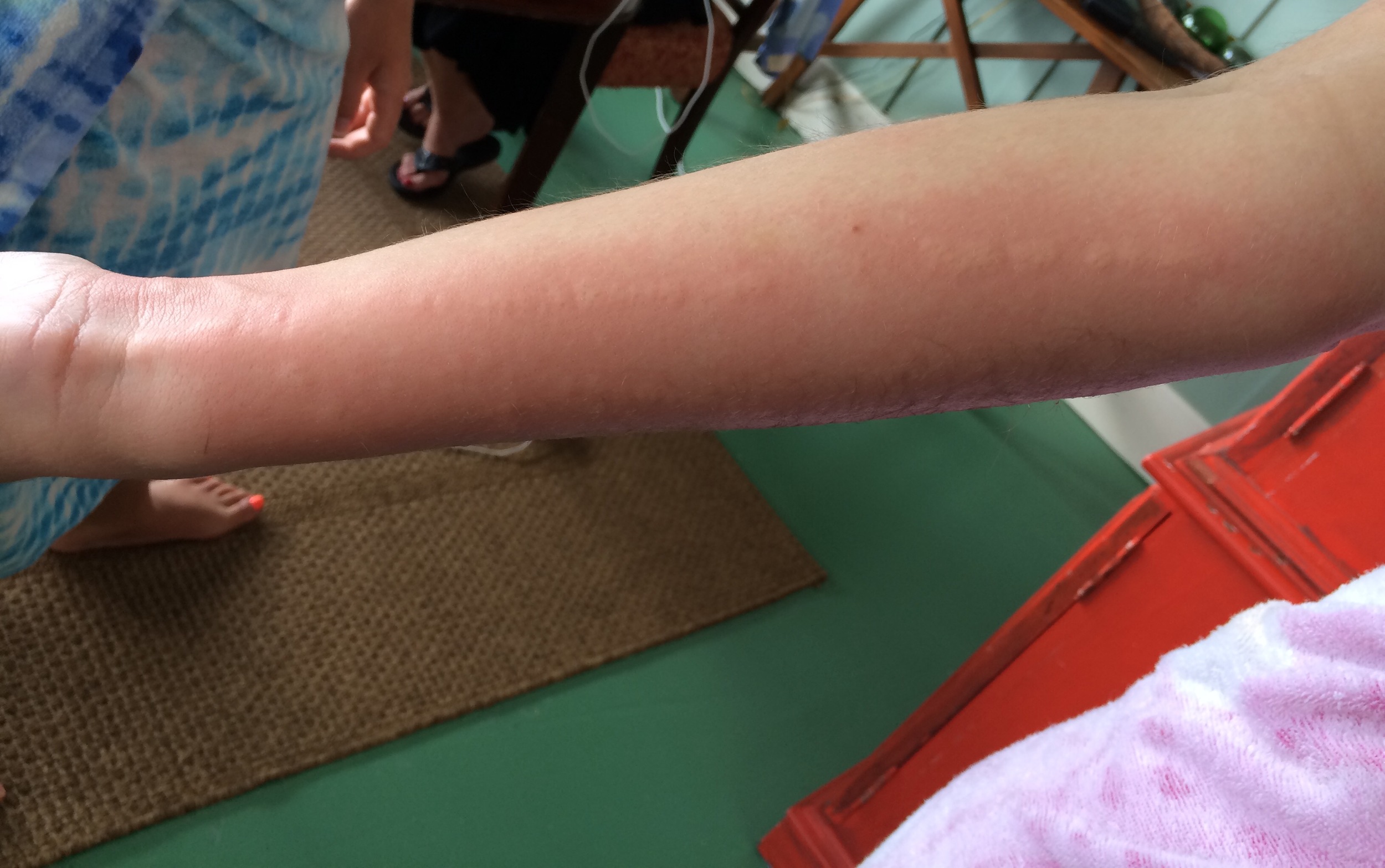 How to Care for Bottlenose and Jellyfish Stings