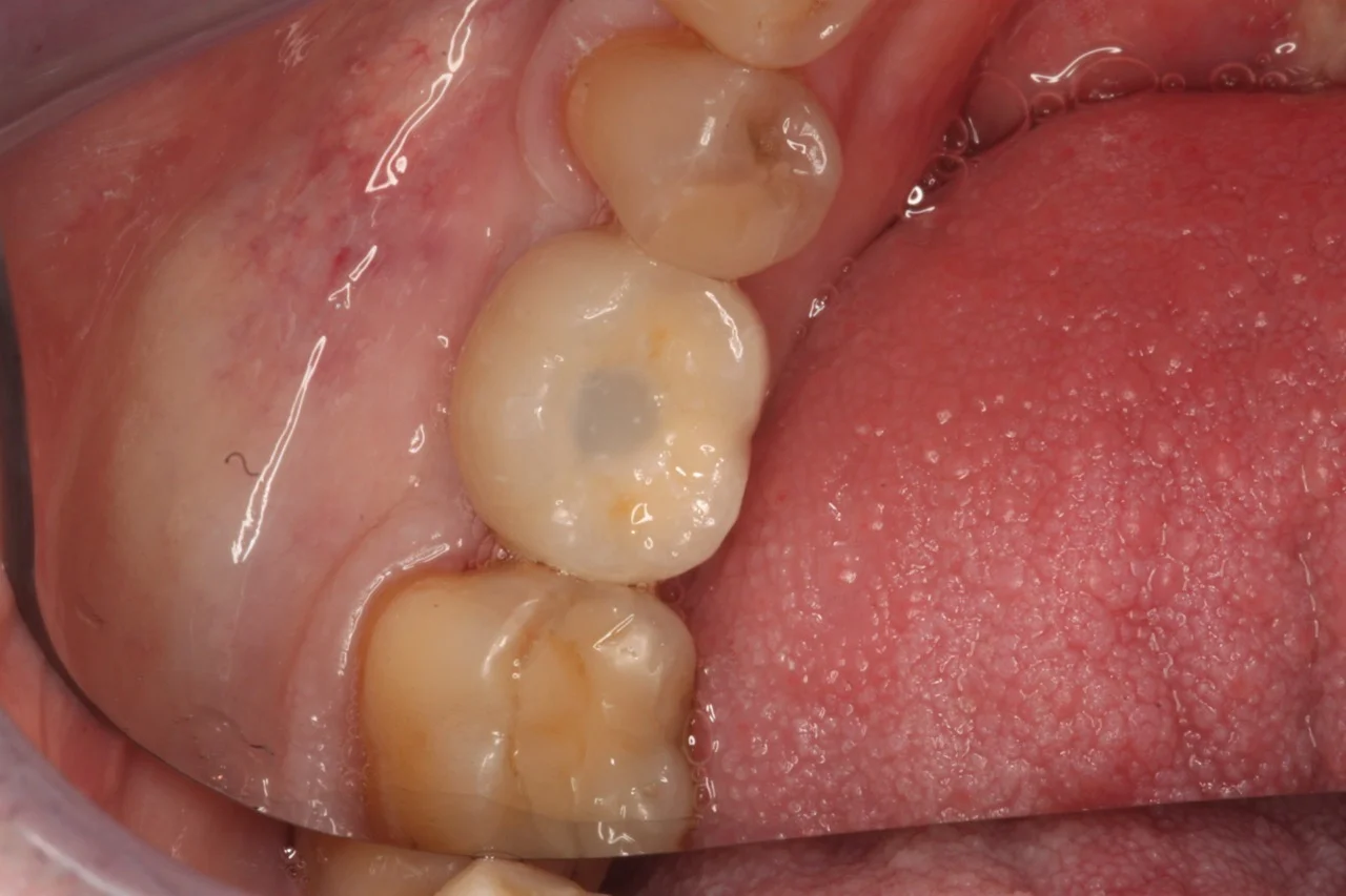 Affordable Dental Implants — Blyton Dental