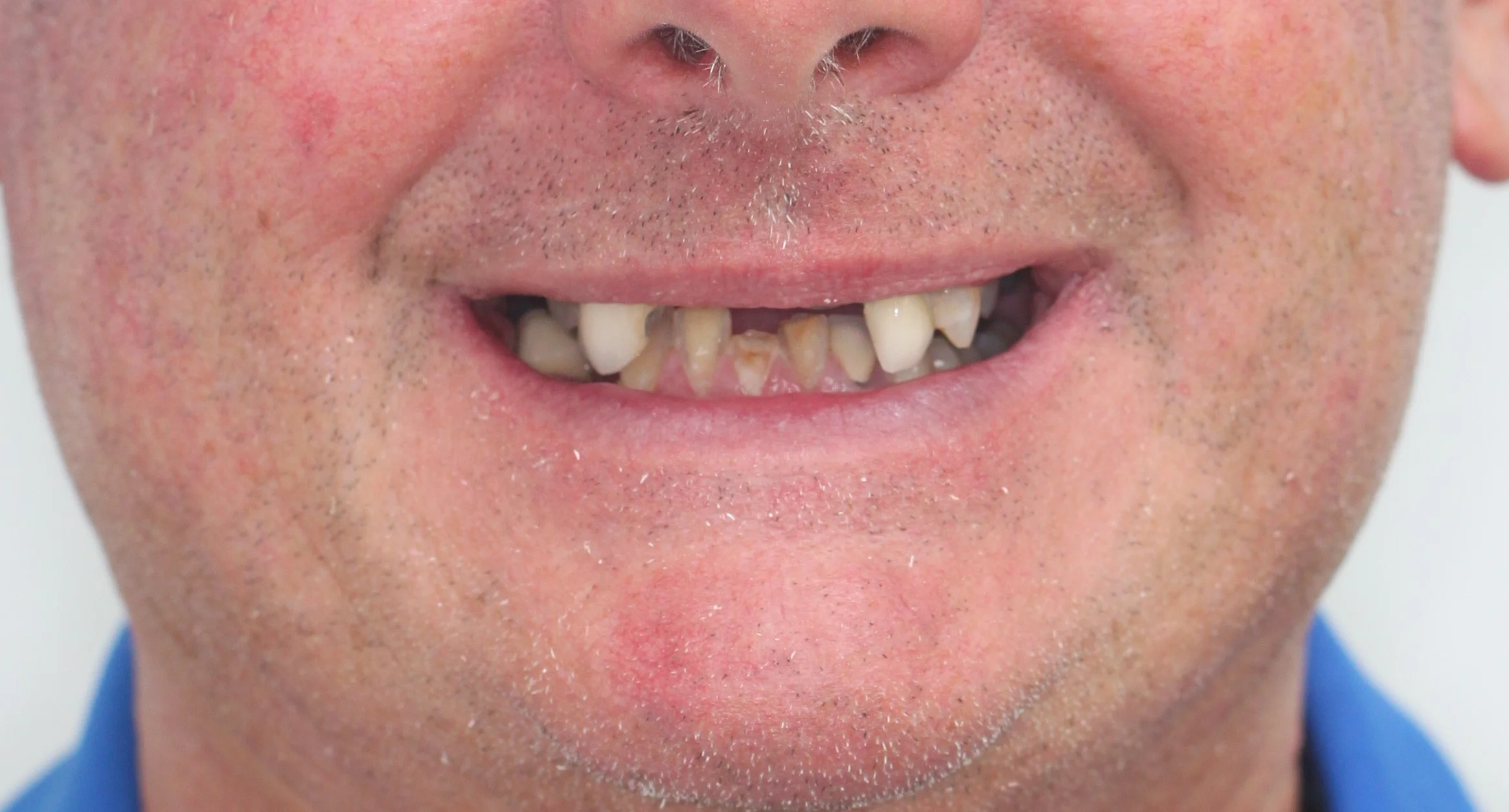 How we can replace missing teeth – Dental Implants — Blyton Dental