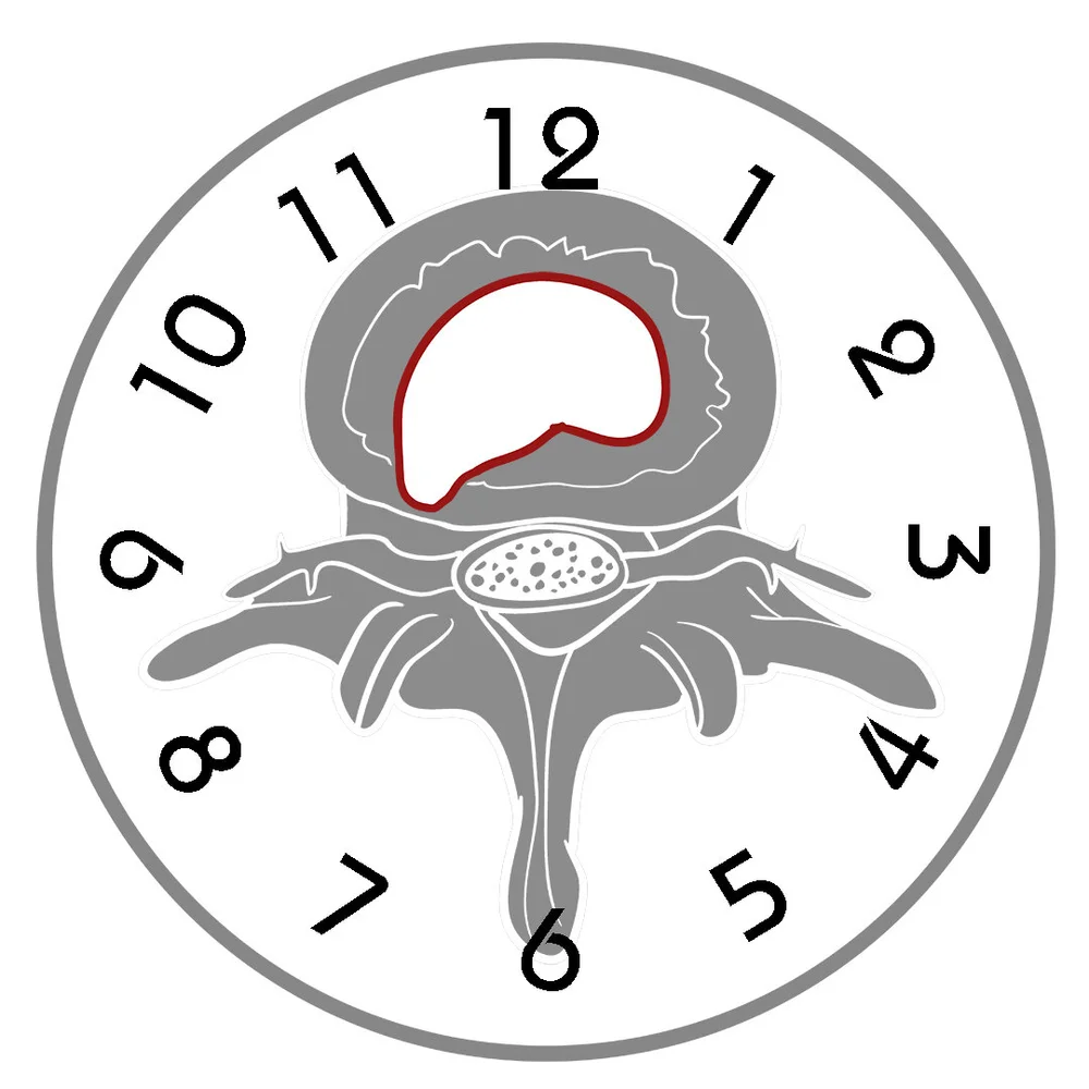 Exercises for a Herniated Disc — Pelvic Clock® Exercise Device