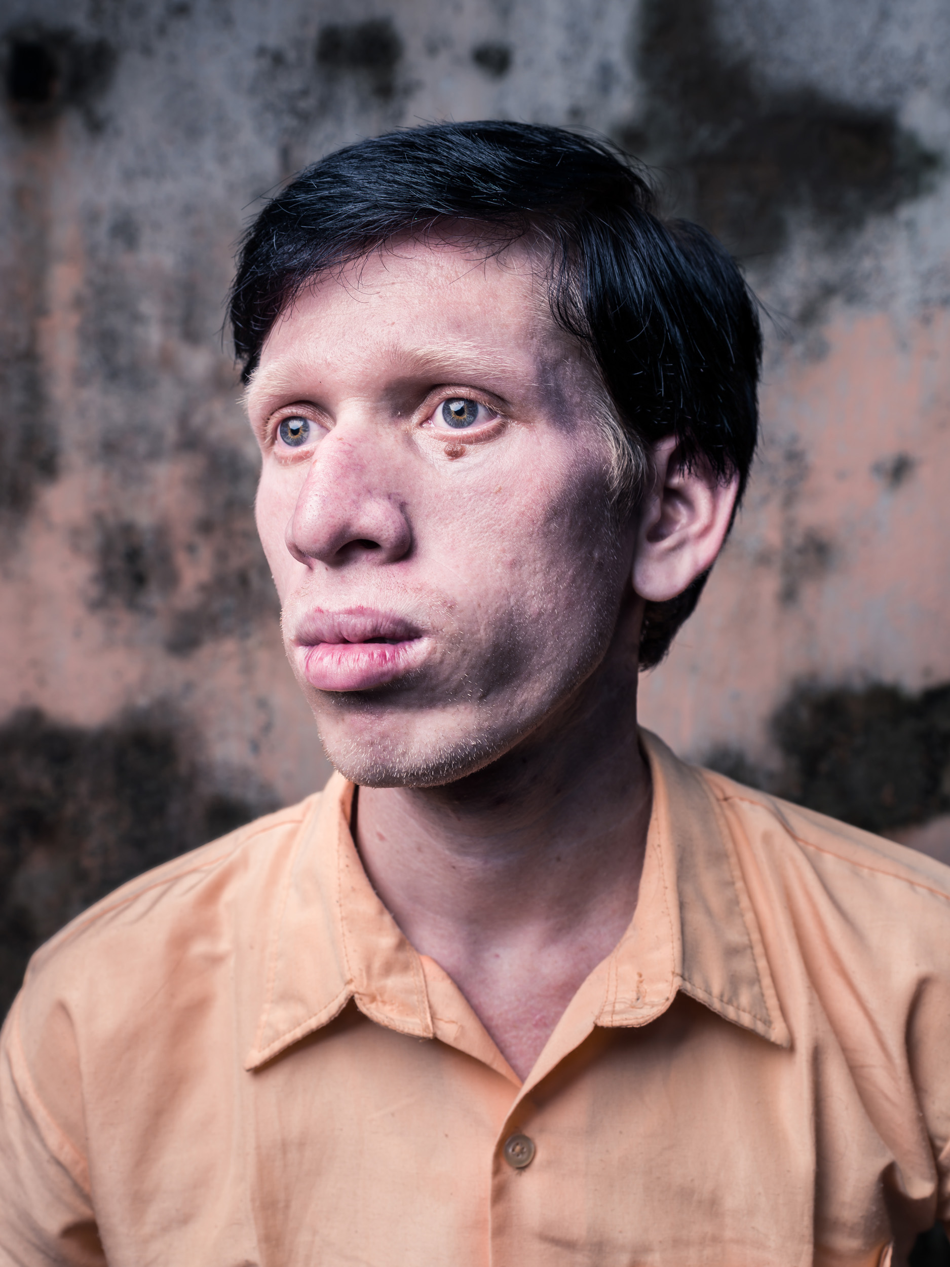 Indian Boys with Albinism — Brent Stirton