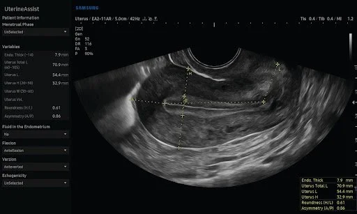 Subjective Uterine Assessments Delay Fertility Care, Increase ...