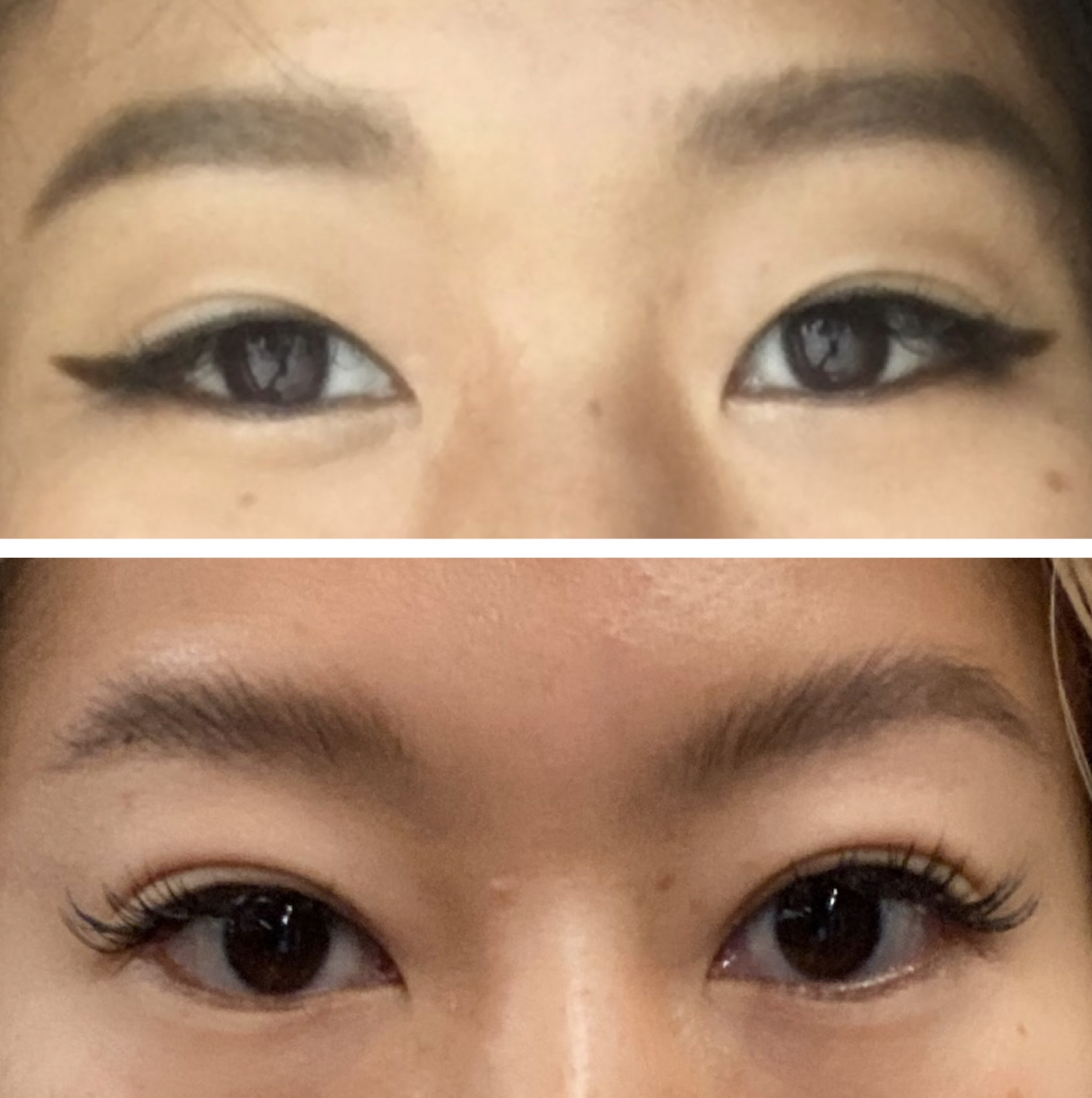 Double eyelid to single eyelid online
