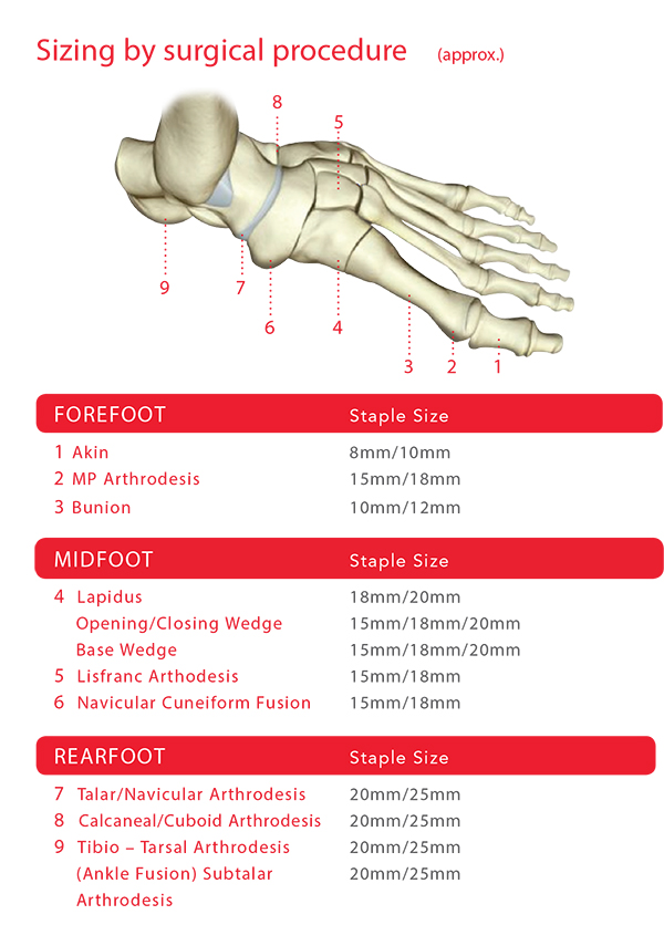 Nitinex Memory Compression Implants — Vilex