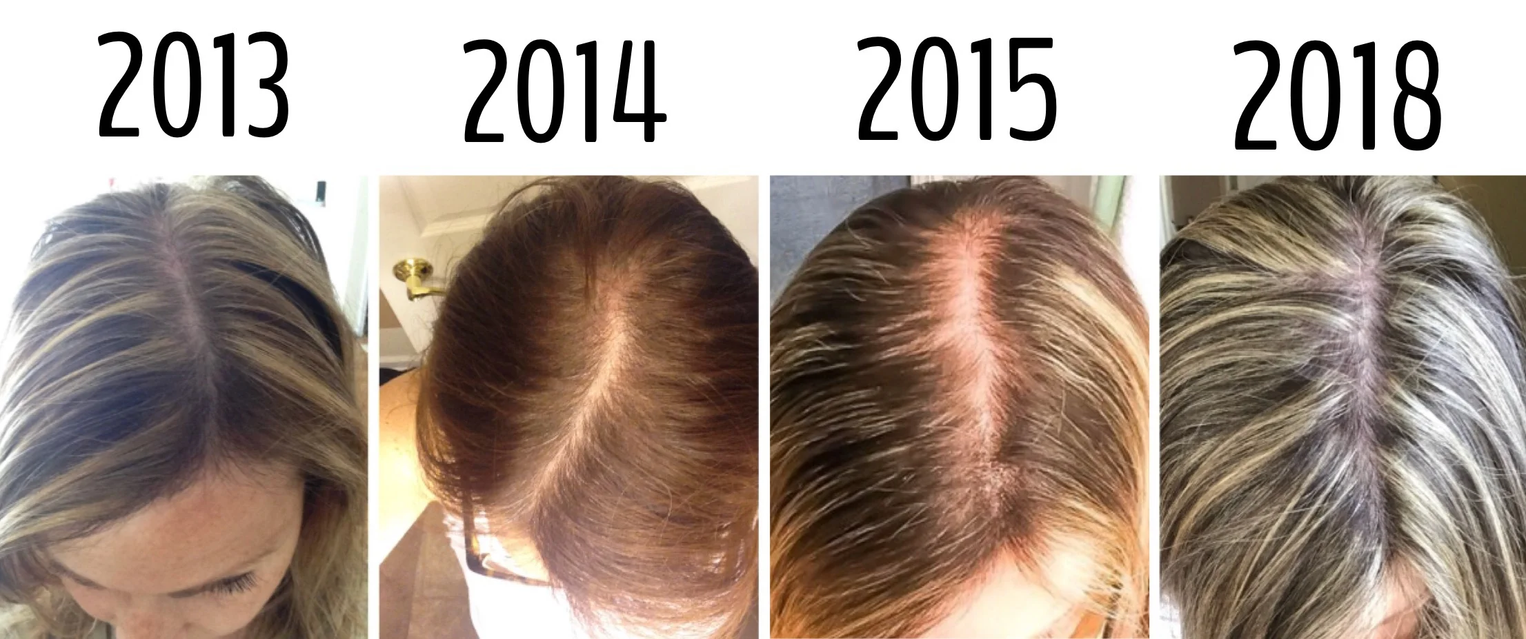 Women And Hair Loss: Causes, Solutions, and Support — First Thyme Mom