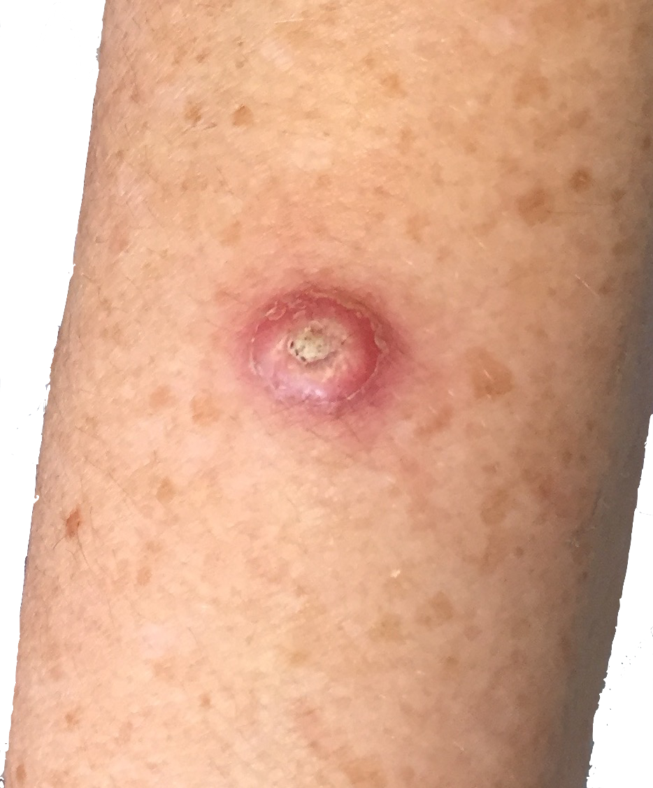 Squamous Cell Carcinoma skin Skin55 Dermatology