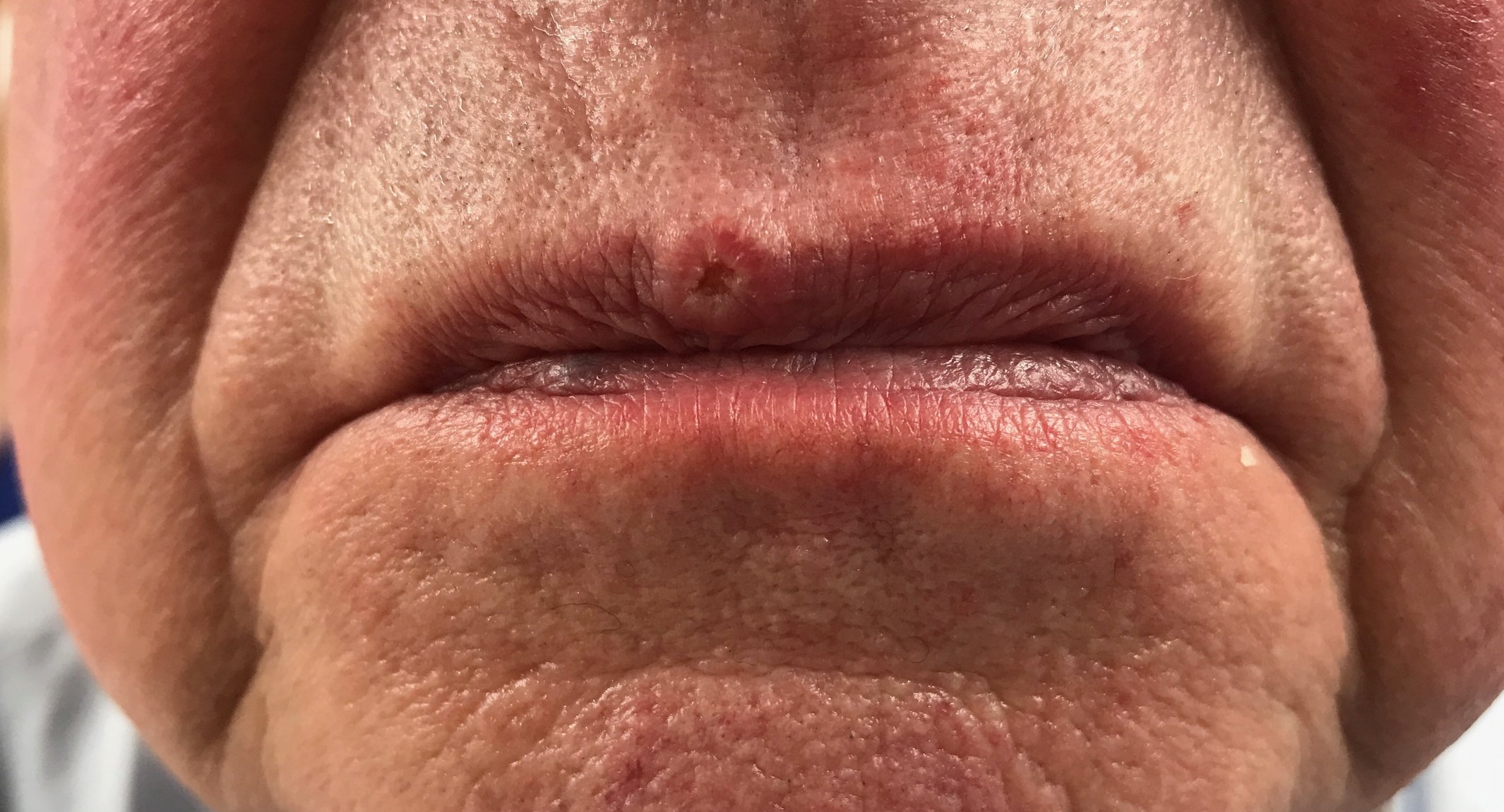 Skin Cancer Pictures Skin55 Skin55 Dermatology Skin Cancer Pictures Skin55 Skin55 Dermatology