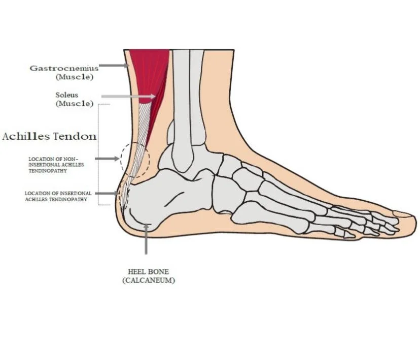 Fit by Physio - Achilles tendinopathy