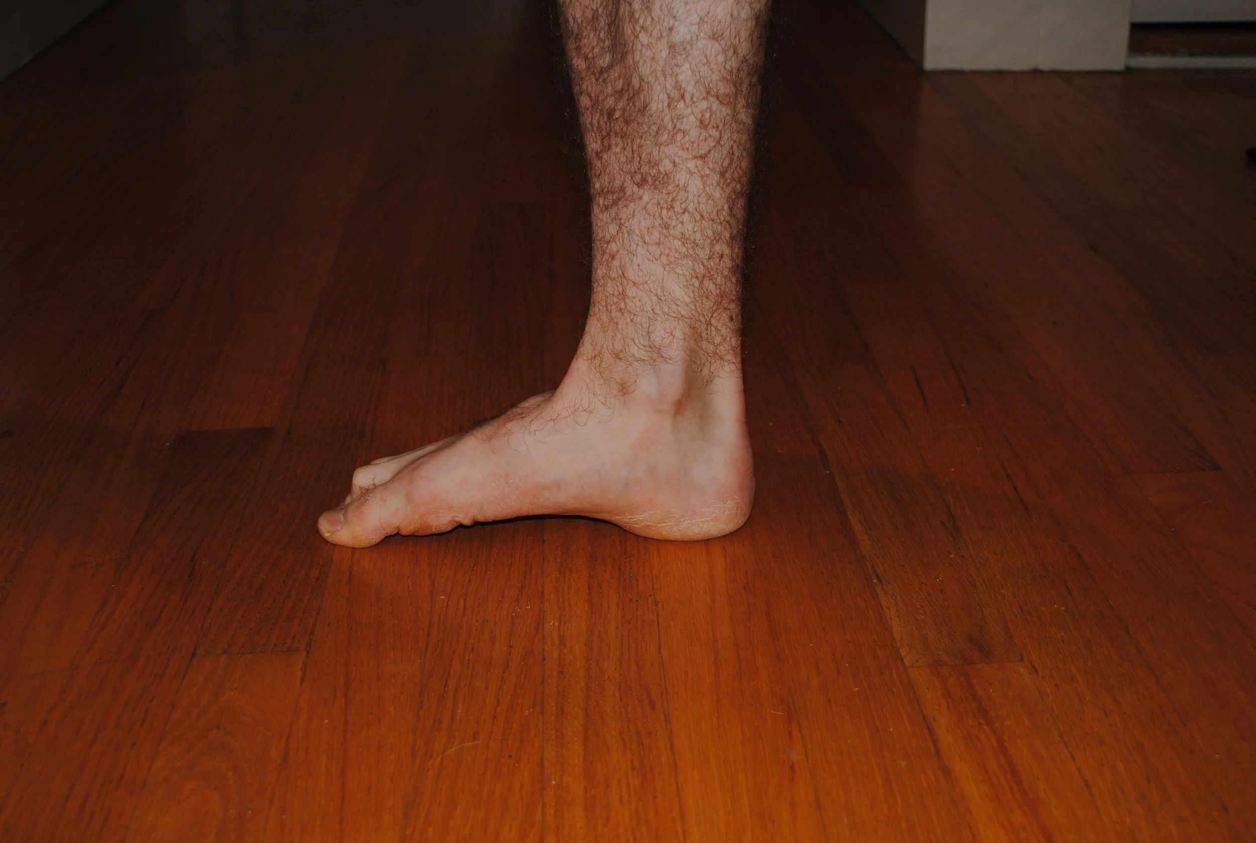 How to Run with Proper Form on a Prosthesis — Prosthetic Running