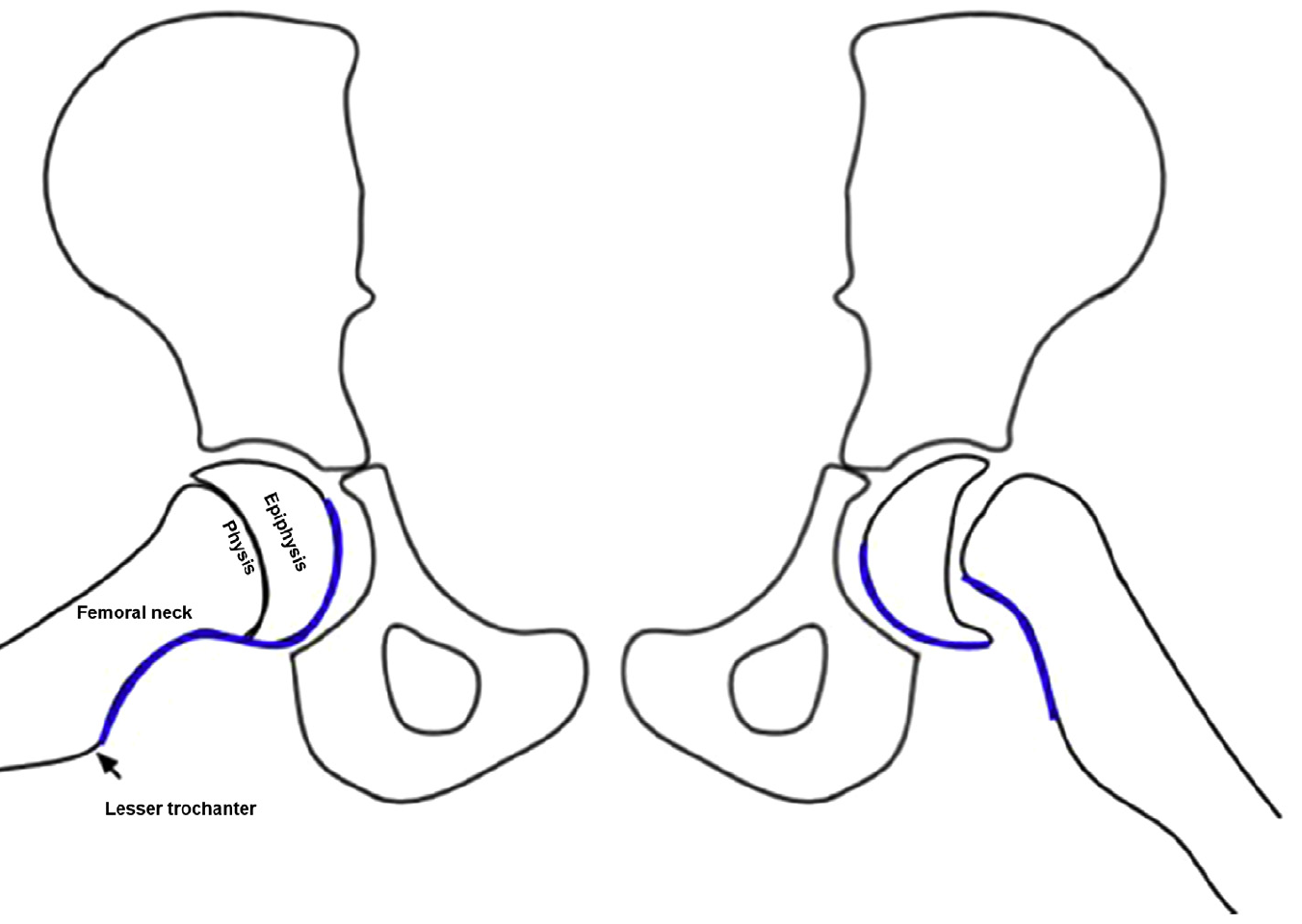 New S-Sign for SCFE + Klein's Line — JournalFeed