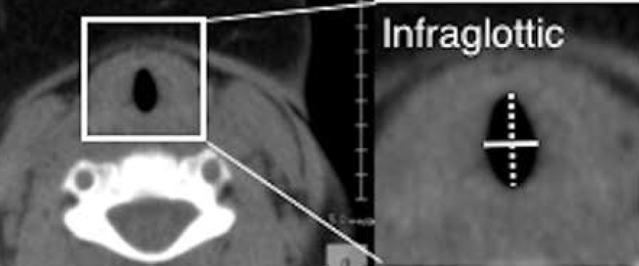 What’s the Right Pediatric ETT Size? — JournalFeed