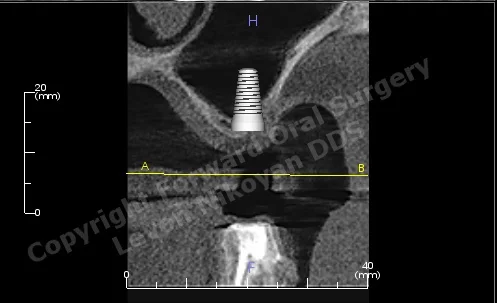 Forward Oral Surgery