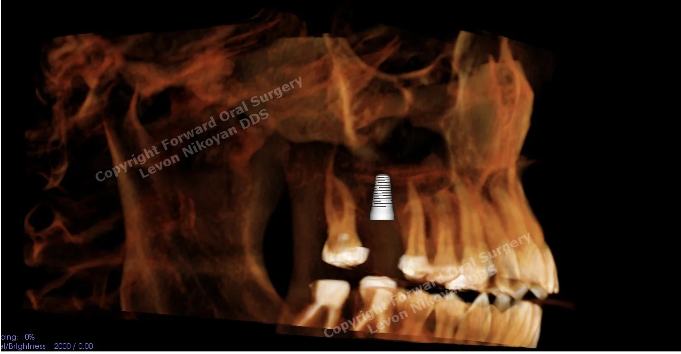 Forward Oral Surgery