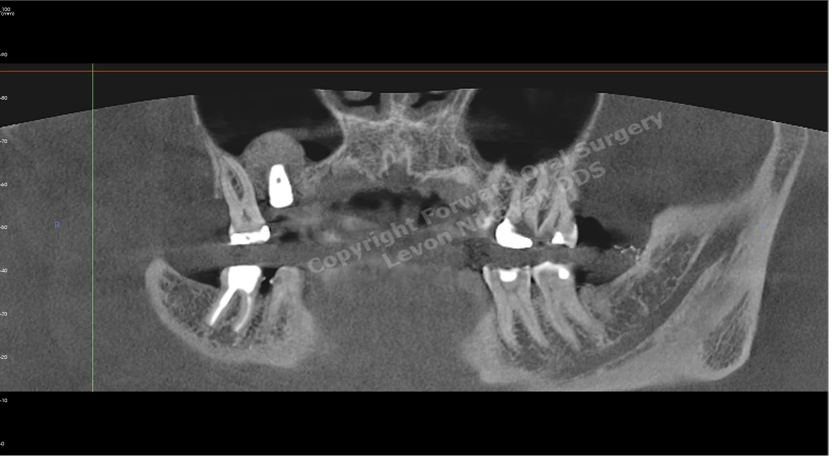 Forward Oral Surgery