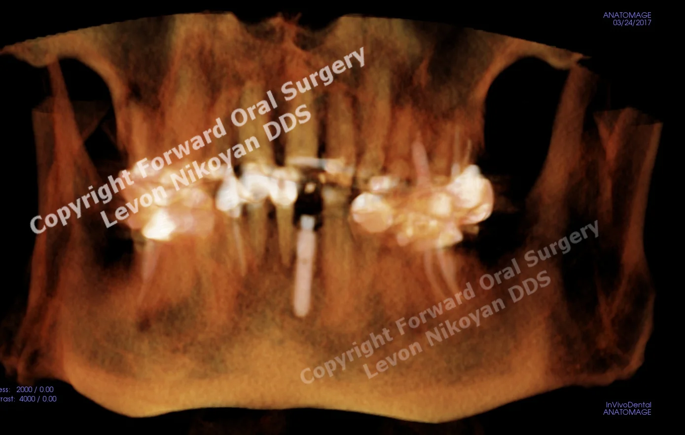 Forward Oral Surgery