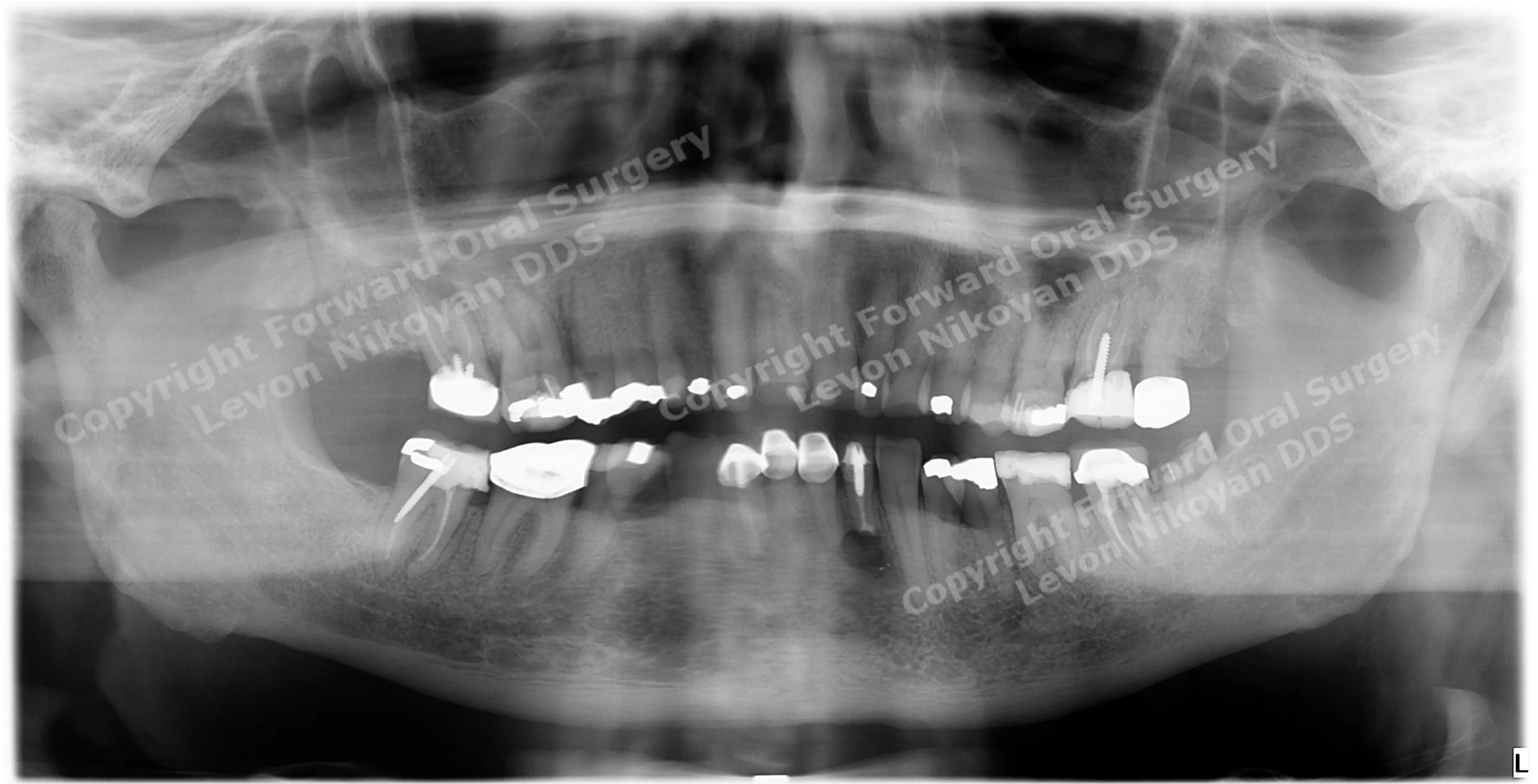 Forward Oral Surgery
