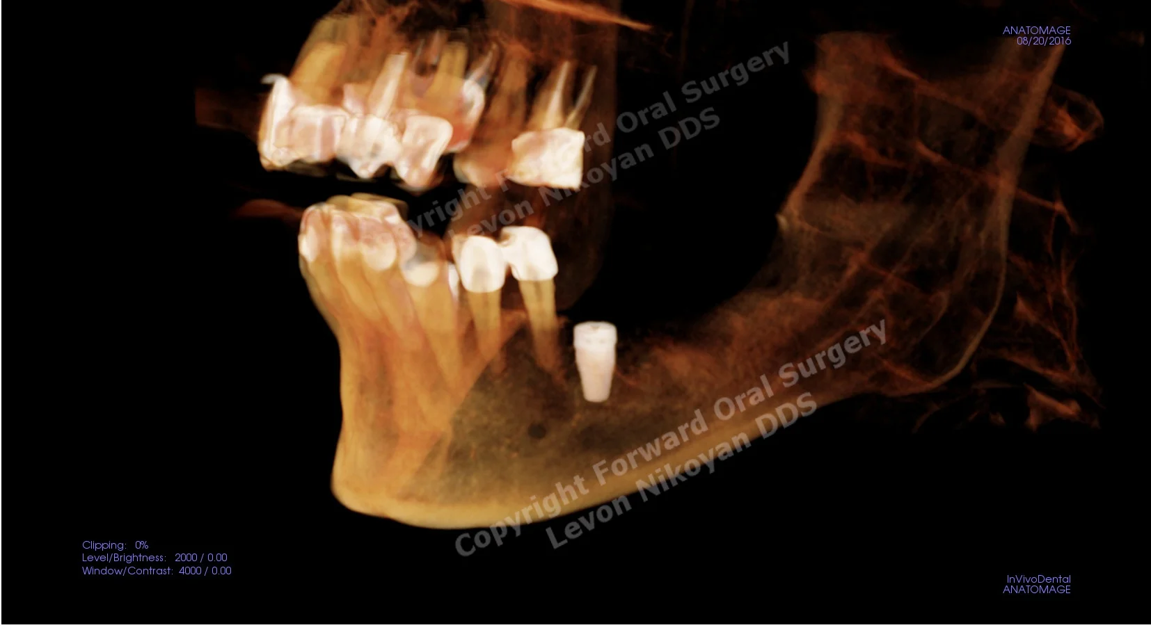Forward Oral Surgery