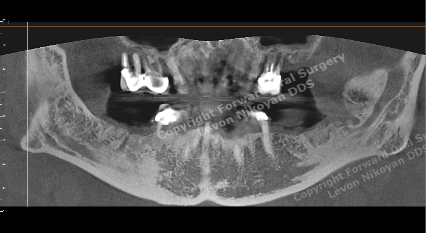 Forward Oral Surgery