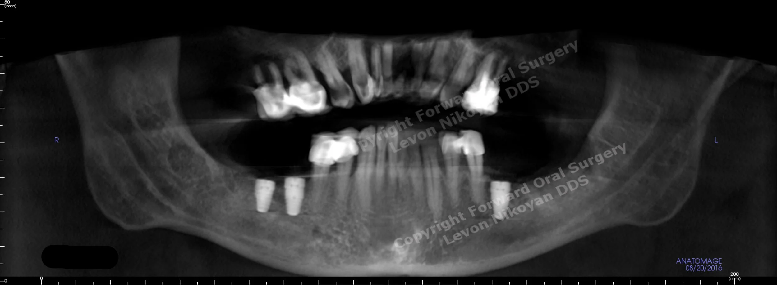 Forward Oral Surgery
