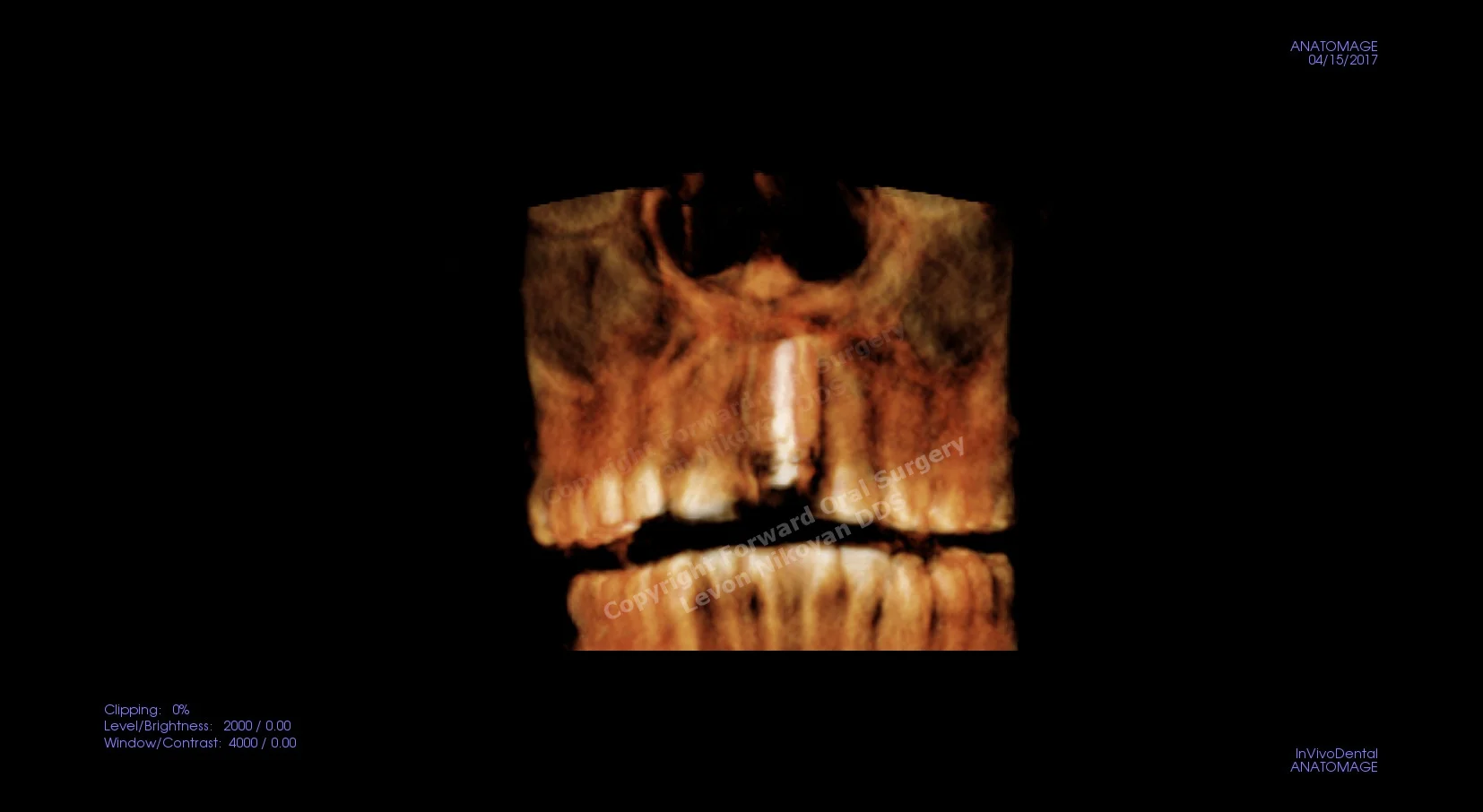 Forward Oral Surgery