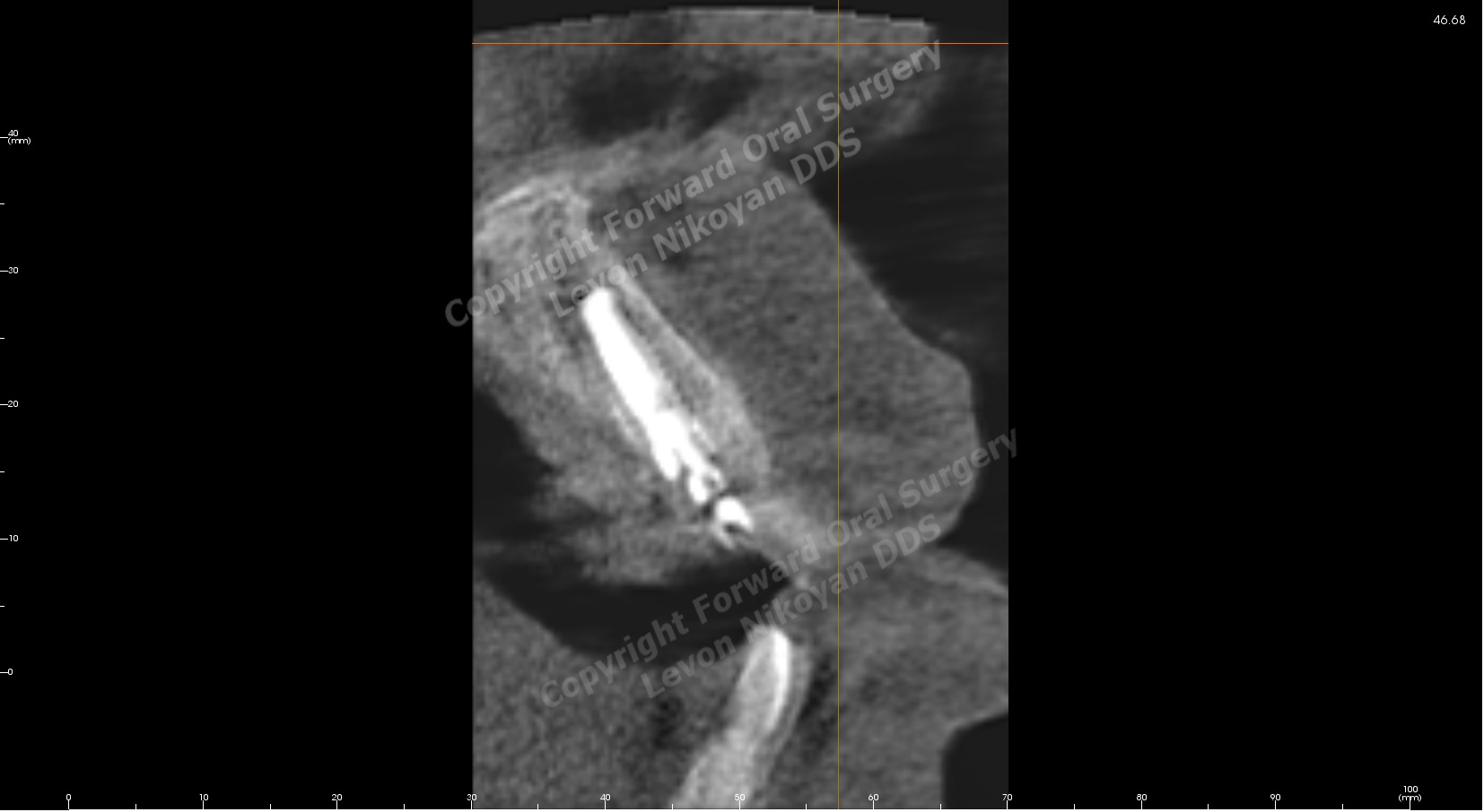 Forward Oral Surgery