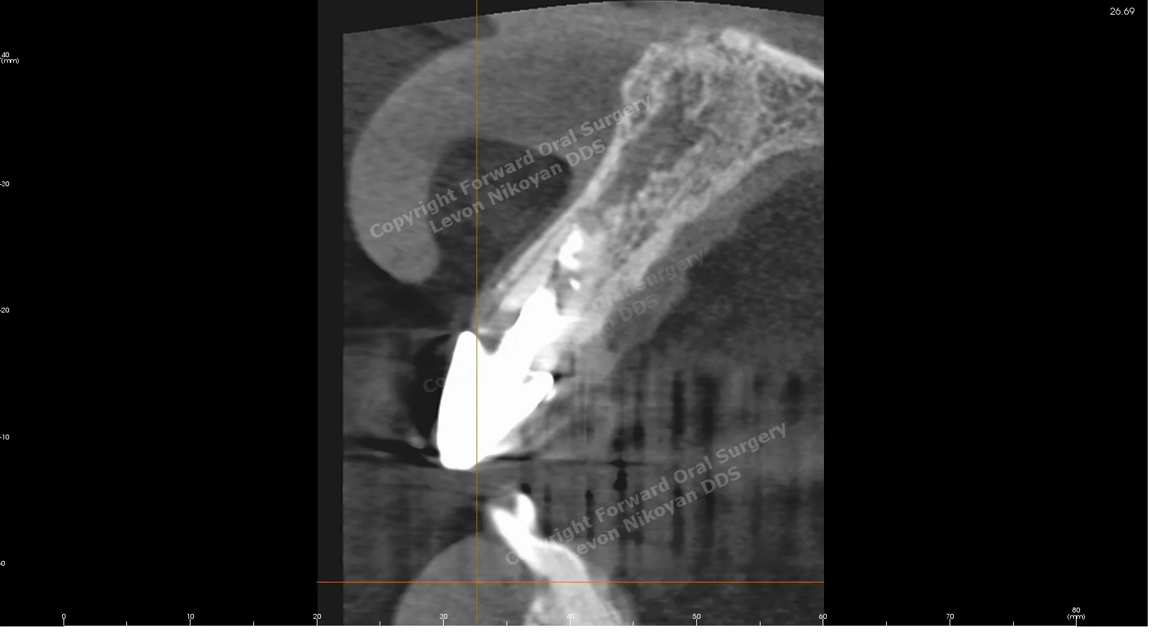 Forward Oral Surgery