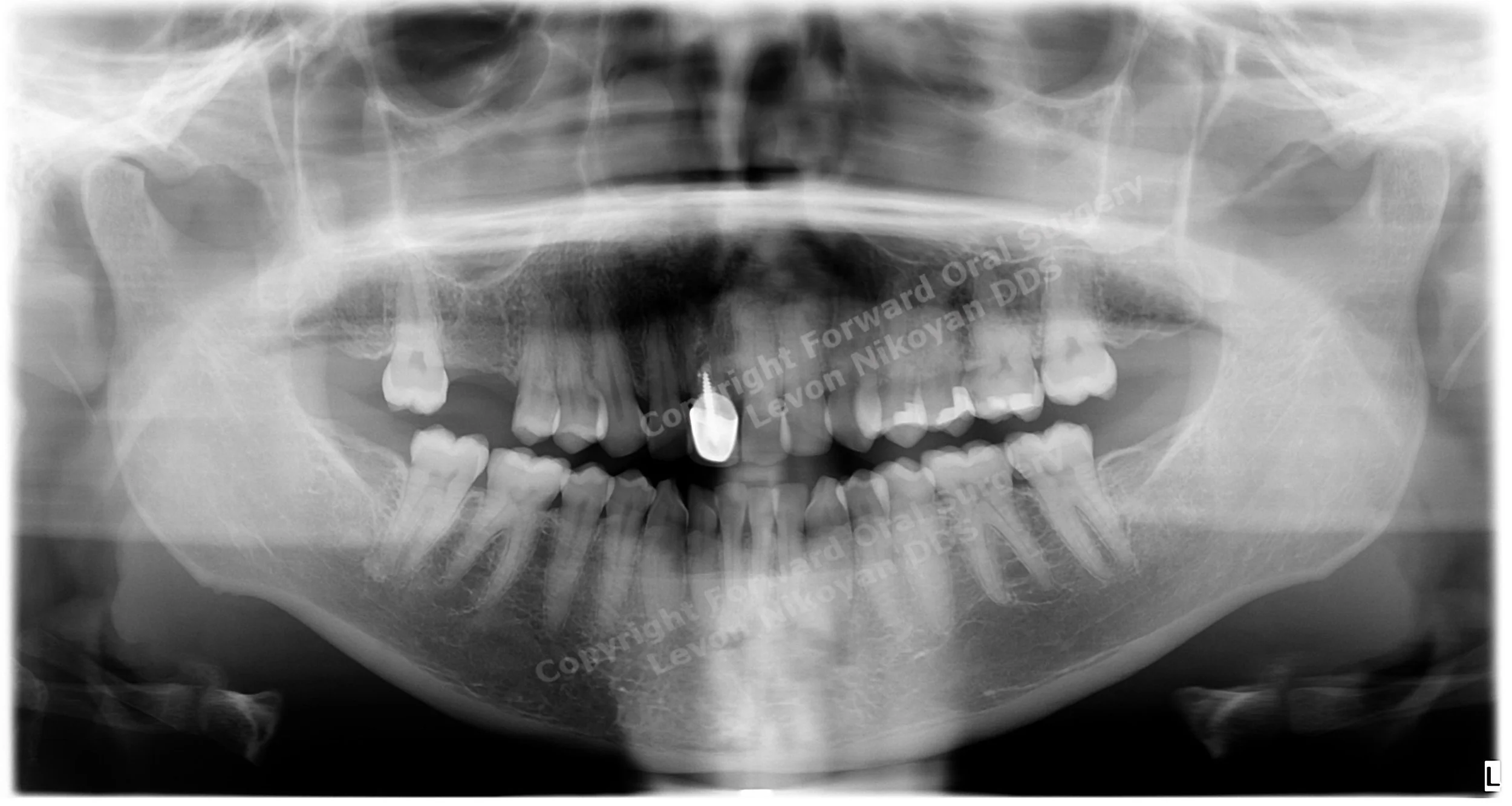 Forward Oral Surgery