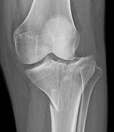 Ortho Pearls: Moped, Mo' Problems. — Cook County Emergency Medicine ...