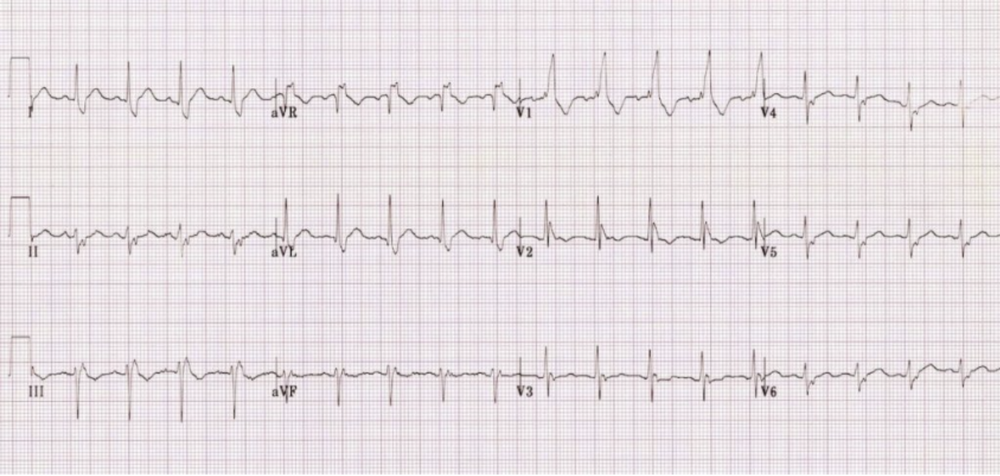 The Heart Of The Matter - A Case of Substernal Chest Pain — Cook County ...