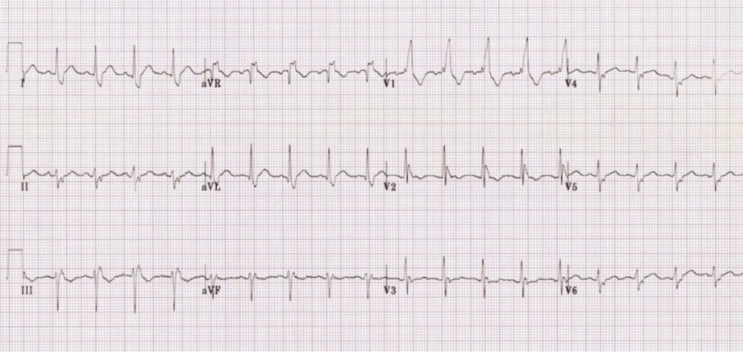 The Heart Of The Matter - A Case of Substernal Chest Pain — Cook County ...