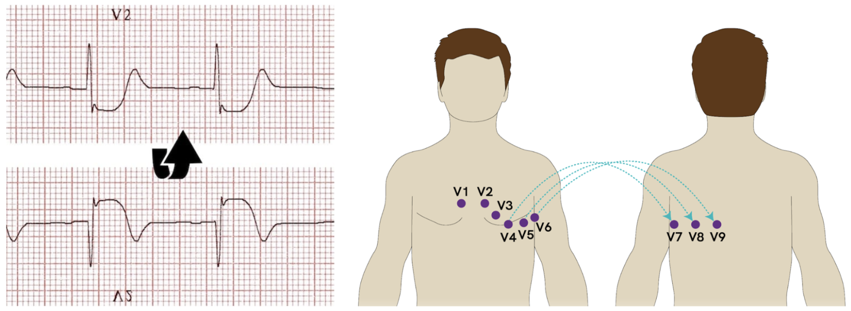 Heart of the Matter: E-aVL-uating for Posterior OMI — Cook County ...