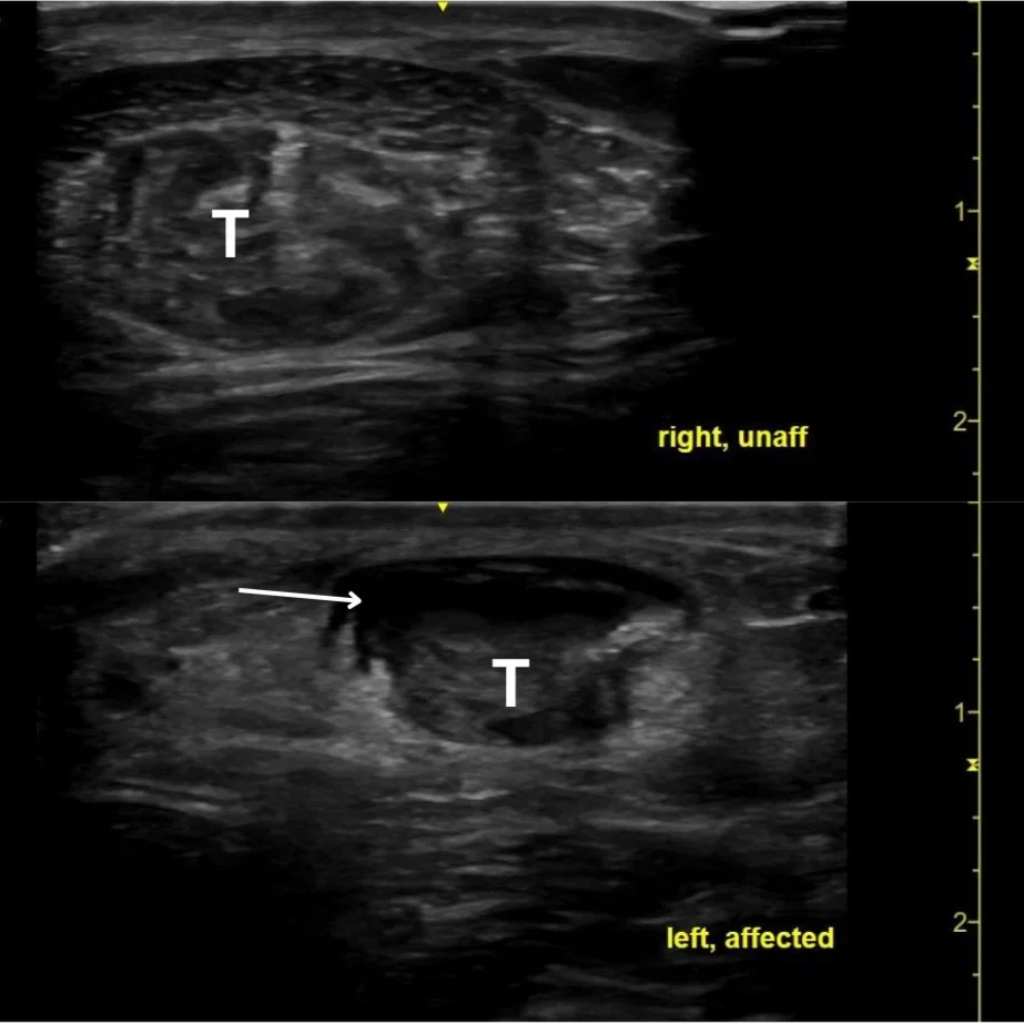 A Case of Achilles Tendon Rupture — Cook County Emergency Medicine ...