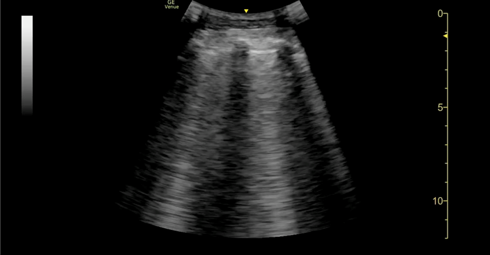 Critical Care Pearls - Sympathetic Crashing Acute Pulmonary Edema ...